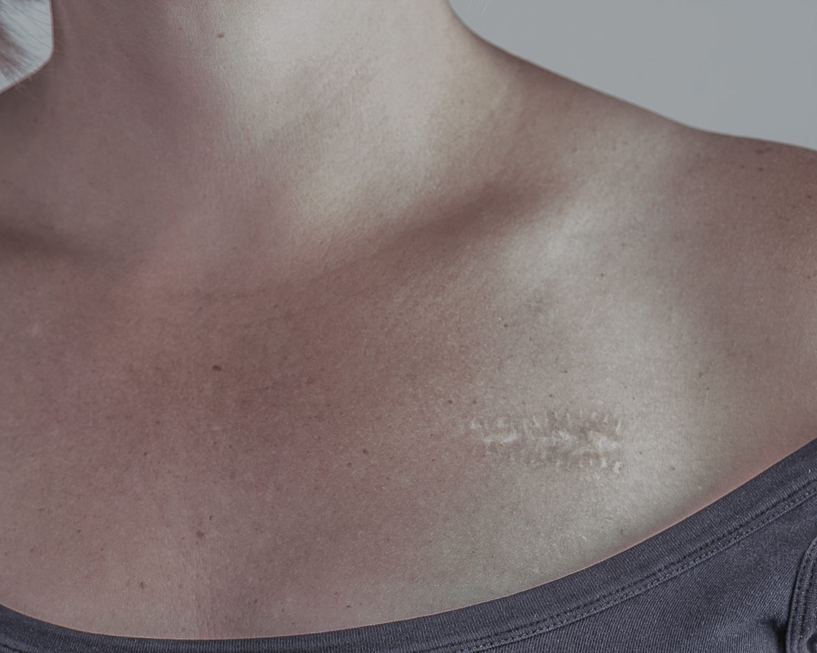 Stronger for their scars | CBC News