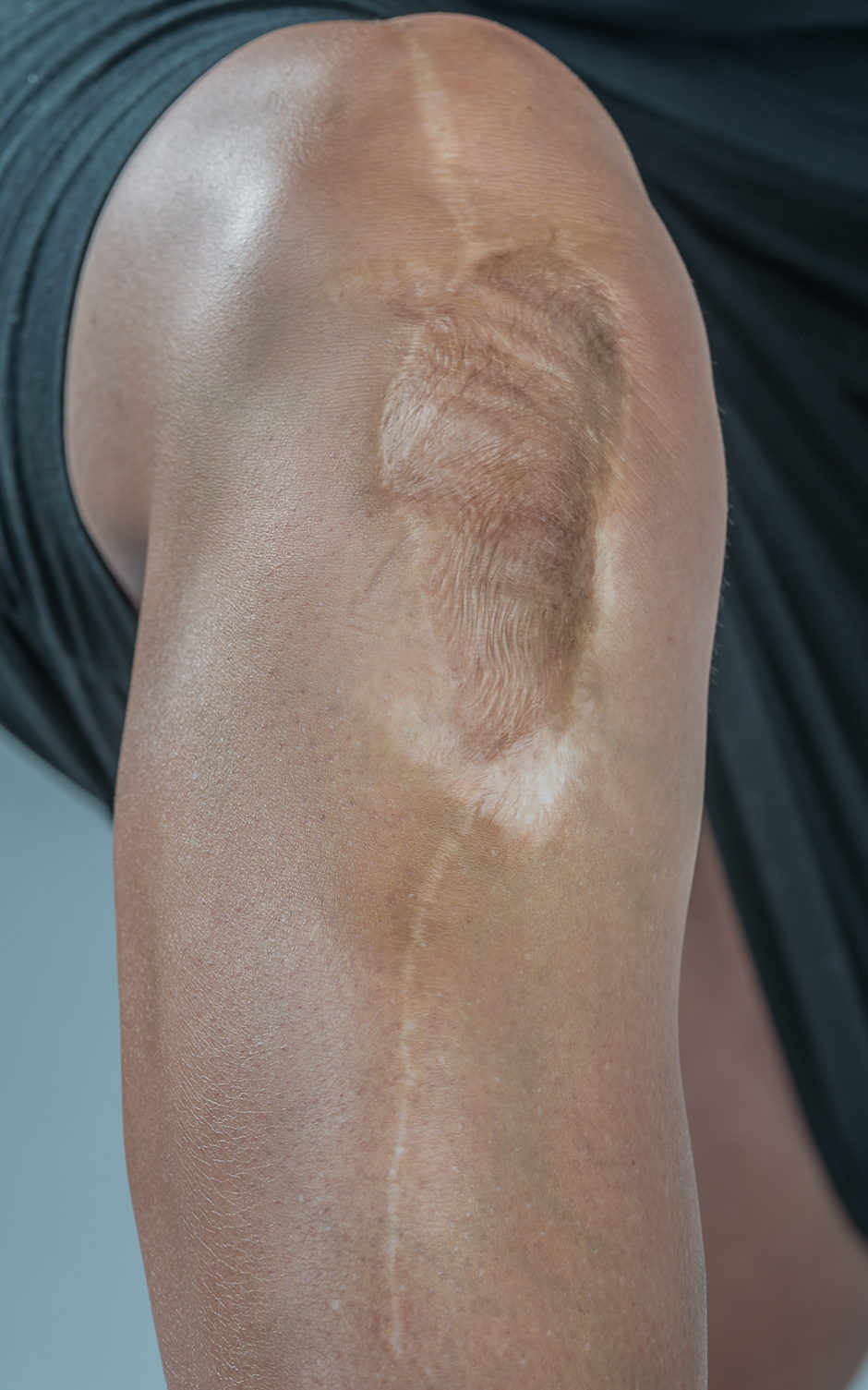 Stronger for their scars | CBC News